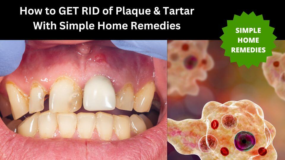 How To Get Rid of Plaque & Tartar Home Remedies